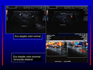 Varicocele | PPSX