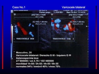Varicocele | PPSX
