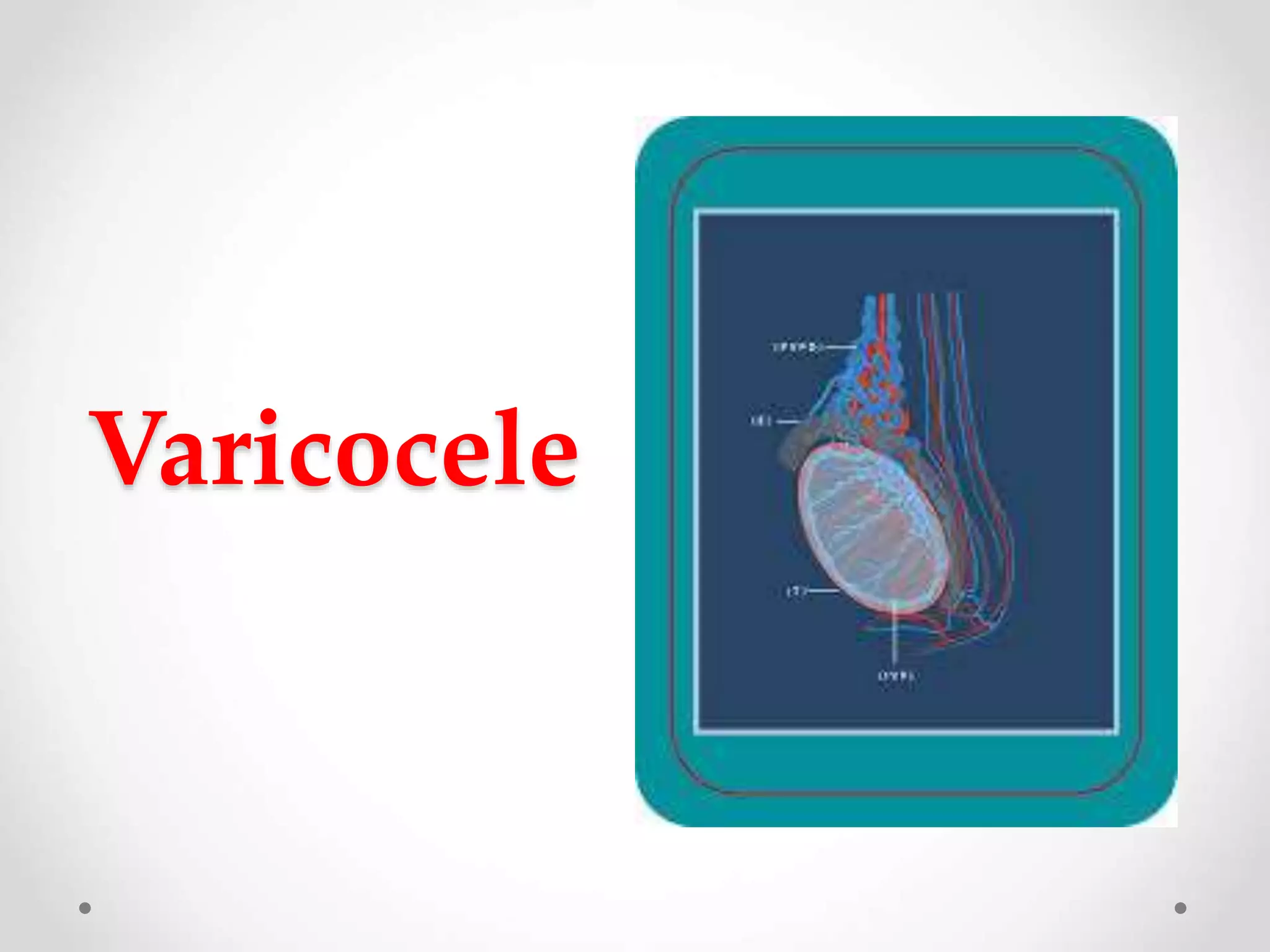 Varicocele & infertility.ppt