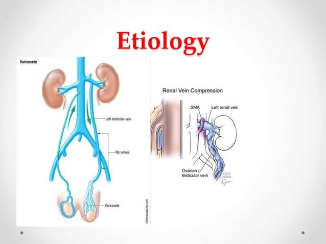 Varicocele & infertility.ppt | Infertility | Reproductive Health