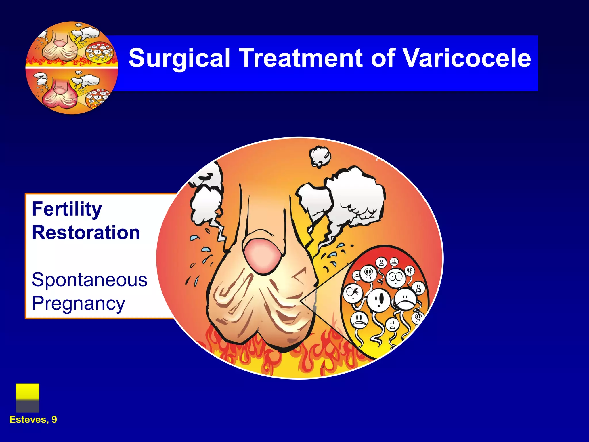 Varicocele in the ICIS Era | PDF