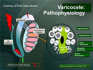 Varicocele in the ICIS Era | PDF