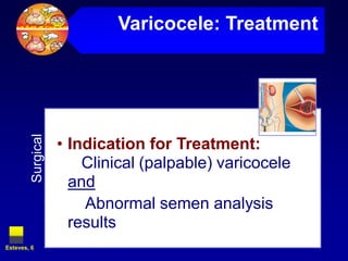 Varicocele in the ICIS Era | PDF