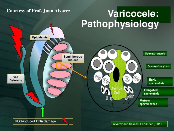 Varicocele In The Icis Era