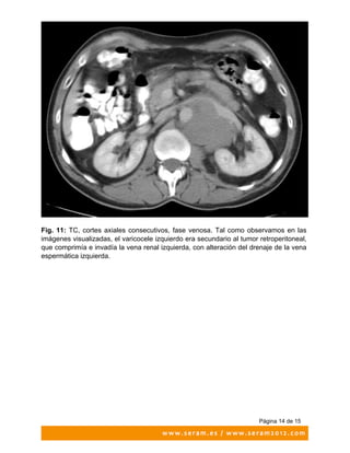 Varicocele seram2012 s-0168 | PDF