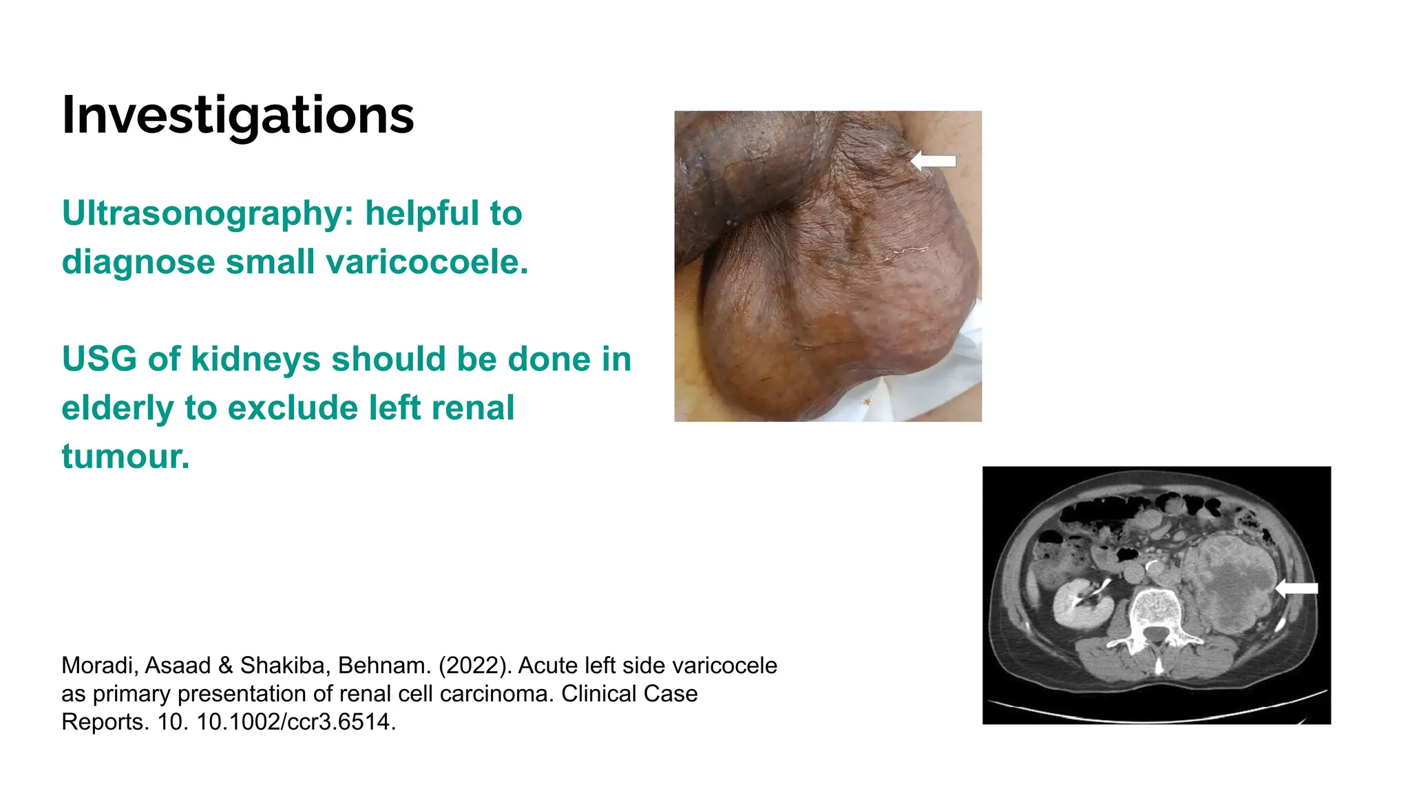Approach to Varicocoele: anatomy, etiology, pathogenesis and management.pdf