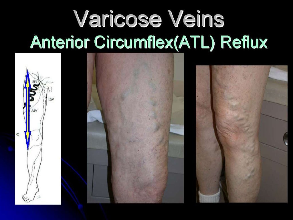 Varicose Veins