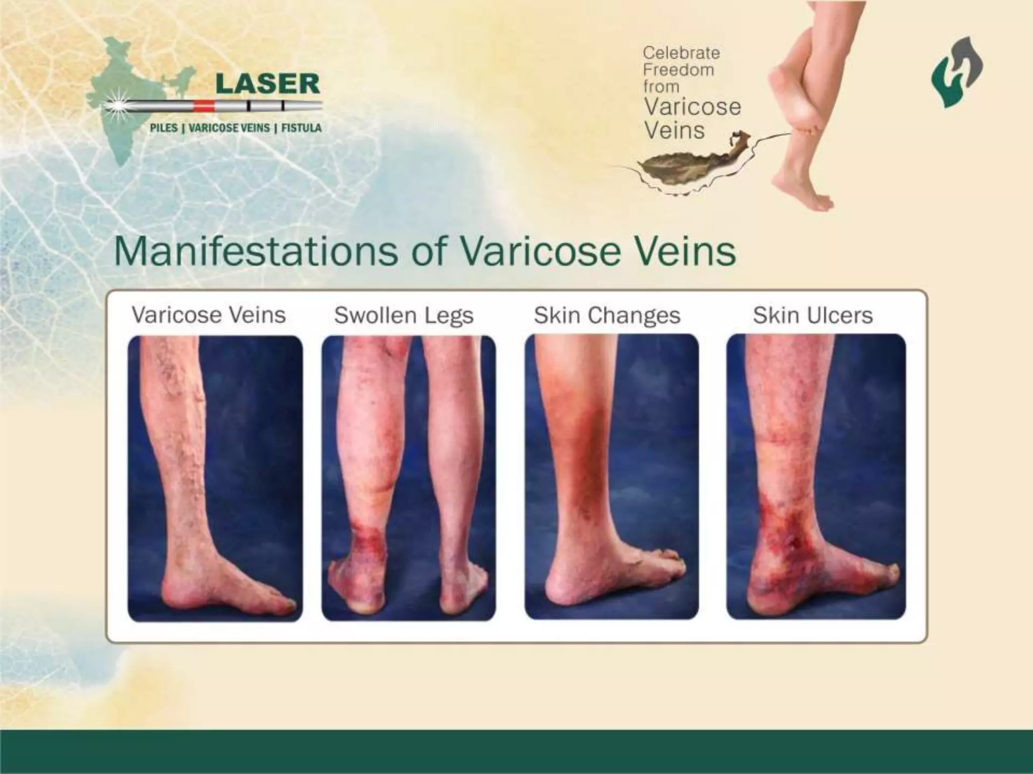 Varicose Veins | All About Varicose Veins | Varicose Veins Treatment | PPTX