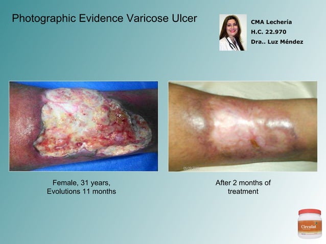 Varicose Ulcer Evidence - Part I- Circulat | PPT