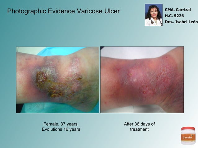 Varicose Ulcer Evidence - Part I- Circulat | PPT