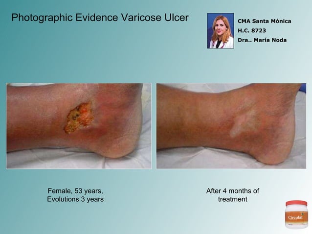 Varicose Ulcer Evidence - Part I- Circulat | PPT