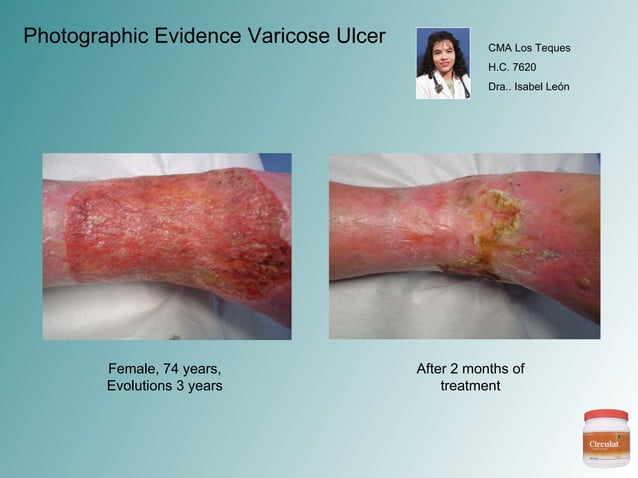 Varicose Ulcer Evidence - Part I- Circulat | PPT