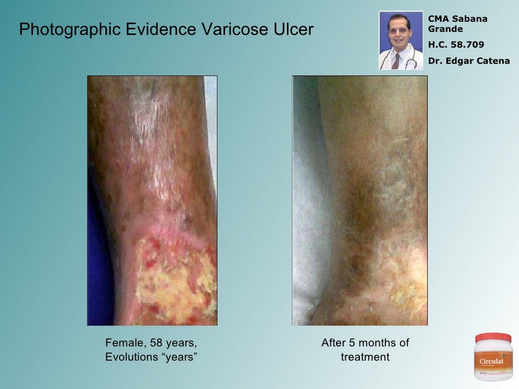 Varicose Ulcer Evidence - Part II - Circulat