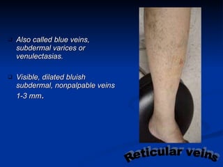 Varicose Vein | PPT
