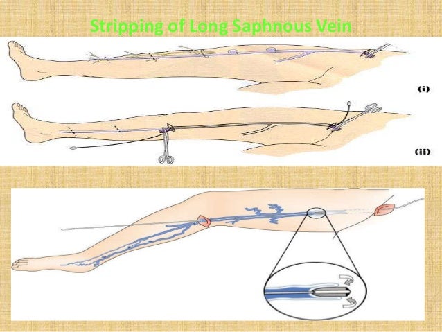 Varicose vein