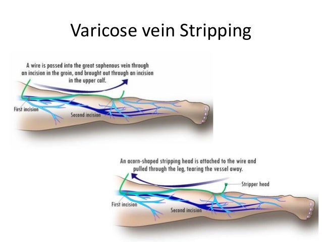 Varicose Vein