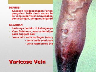 VARICOSE VEIN | PPT