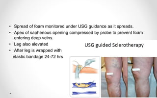 Varicose vein | PPTX