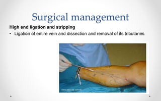 Varicose vein | PPTX