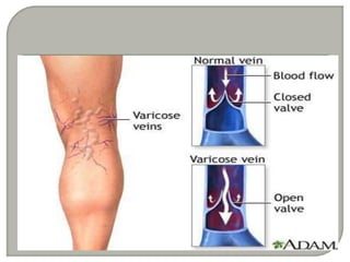 Varicose vein | PPTX