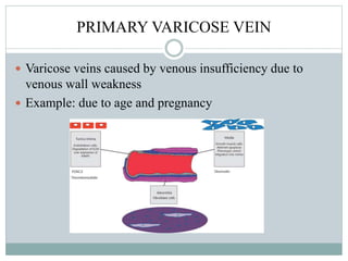 Varicose vein | PPTX