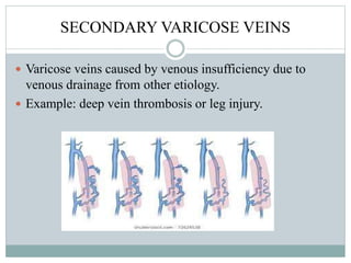 Varicose vein | PPTX