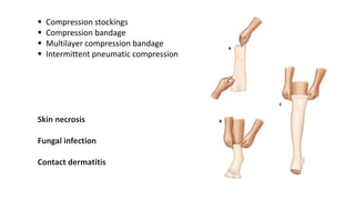 Varicose vein | PPTX