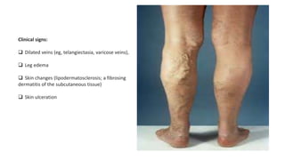 Varicose vein | PPTX