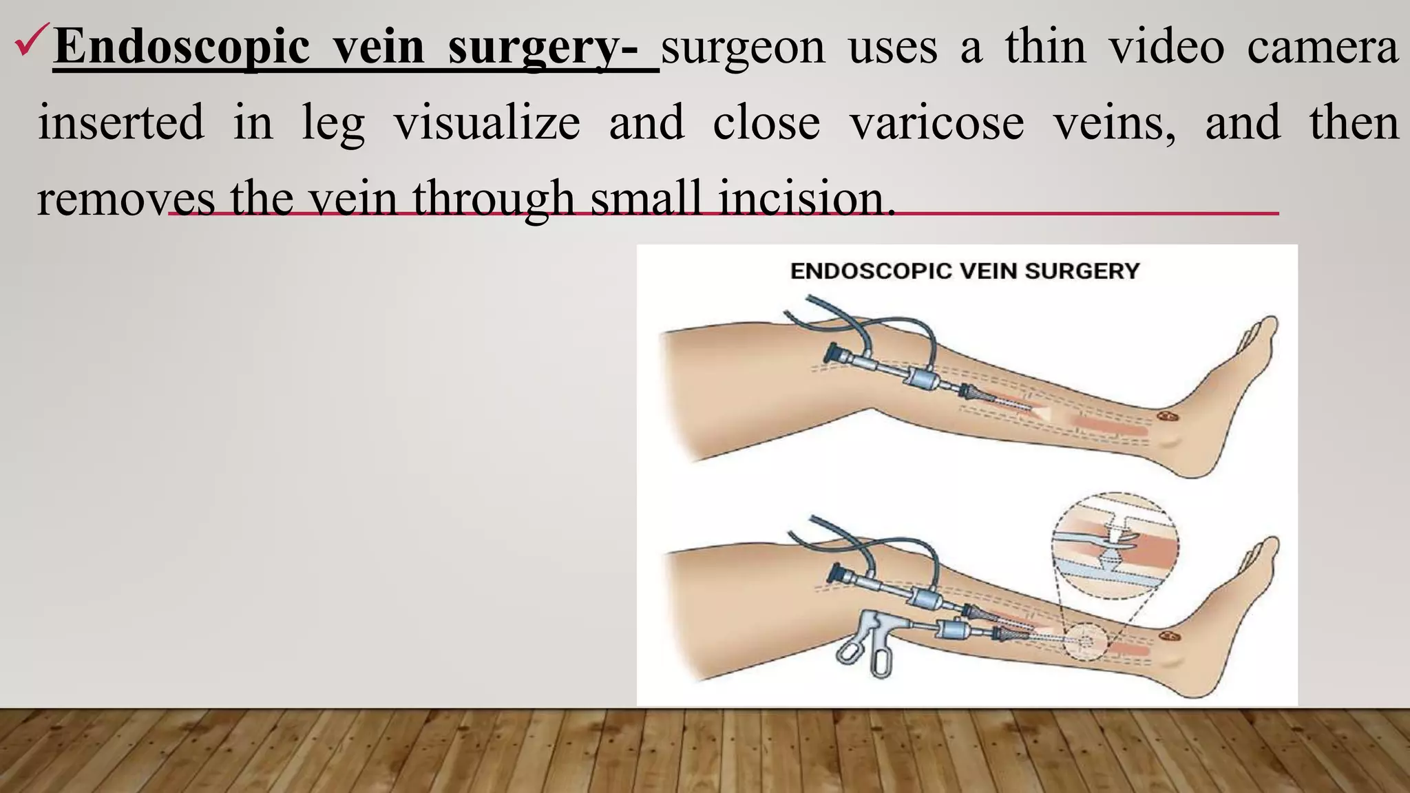 Varicose vein.pdf