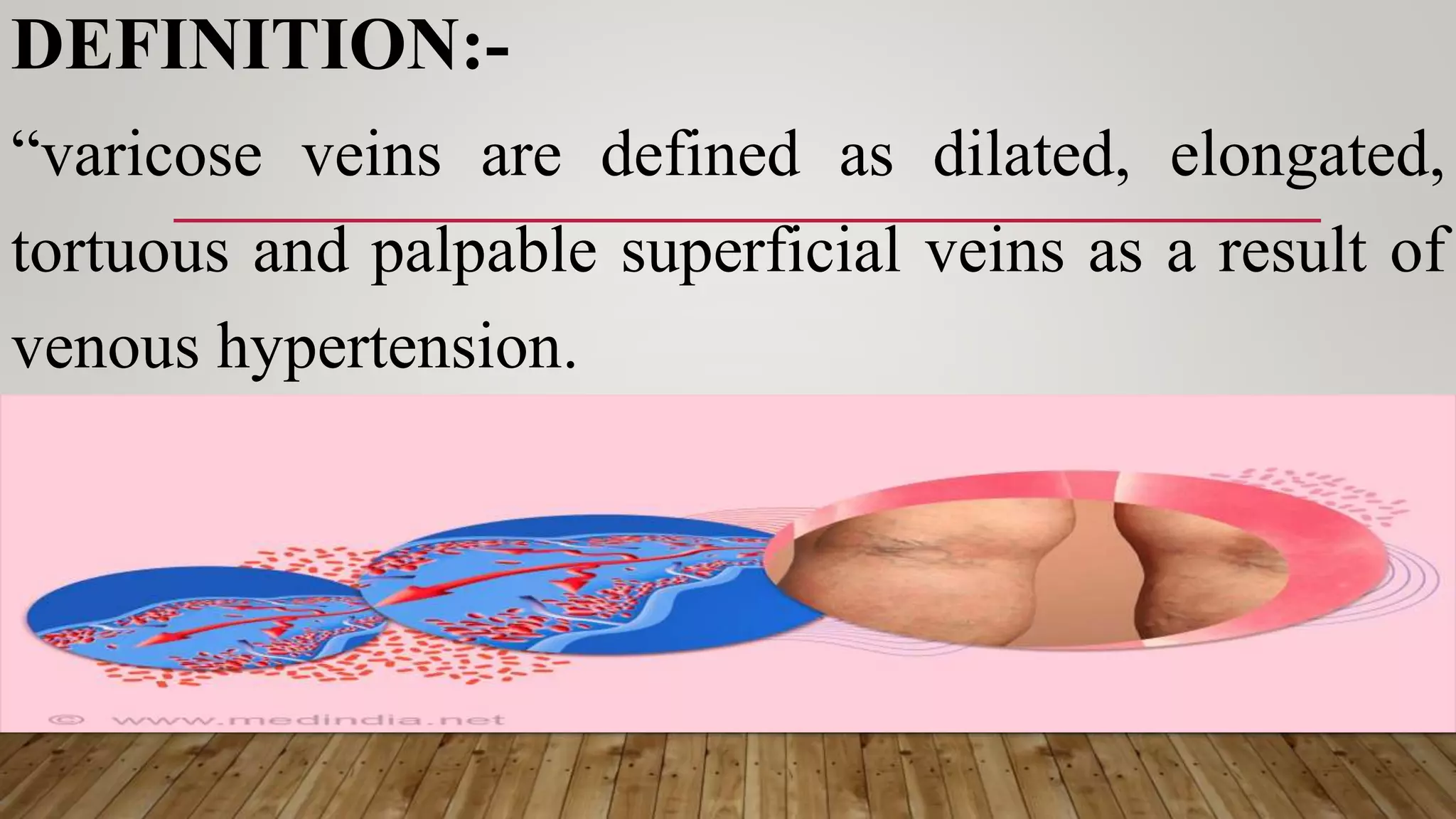 Varicose vein.pdf