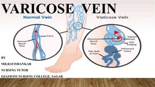 Varicose vein.pdf
