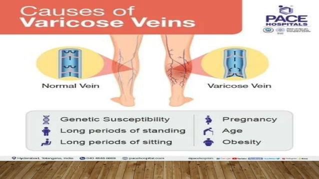 Varicose vein.pdf