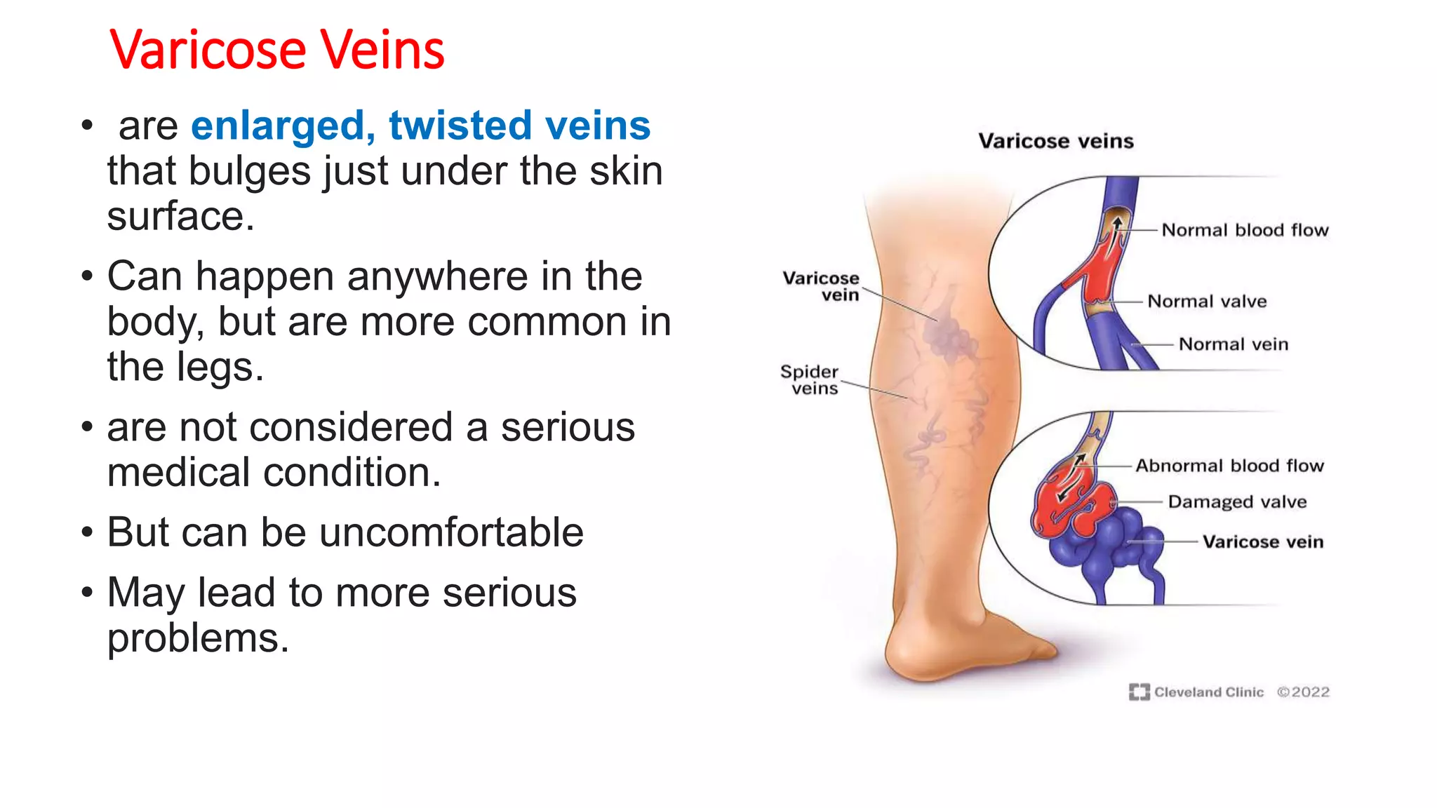 Varicose Vein.pptx