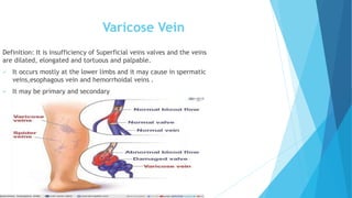 Varicose vein.pptx