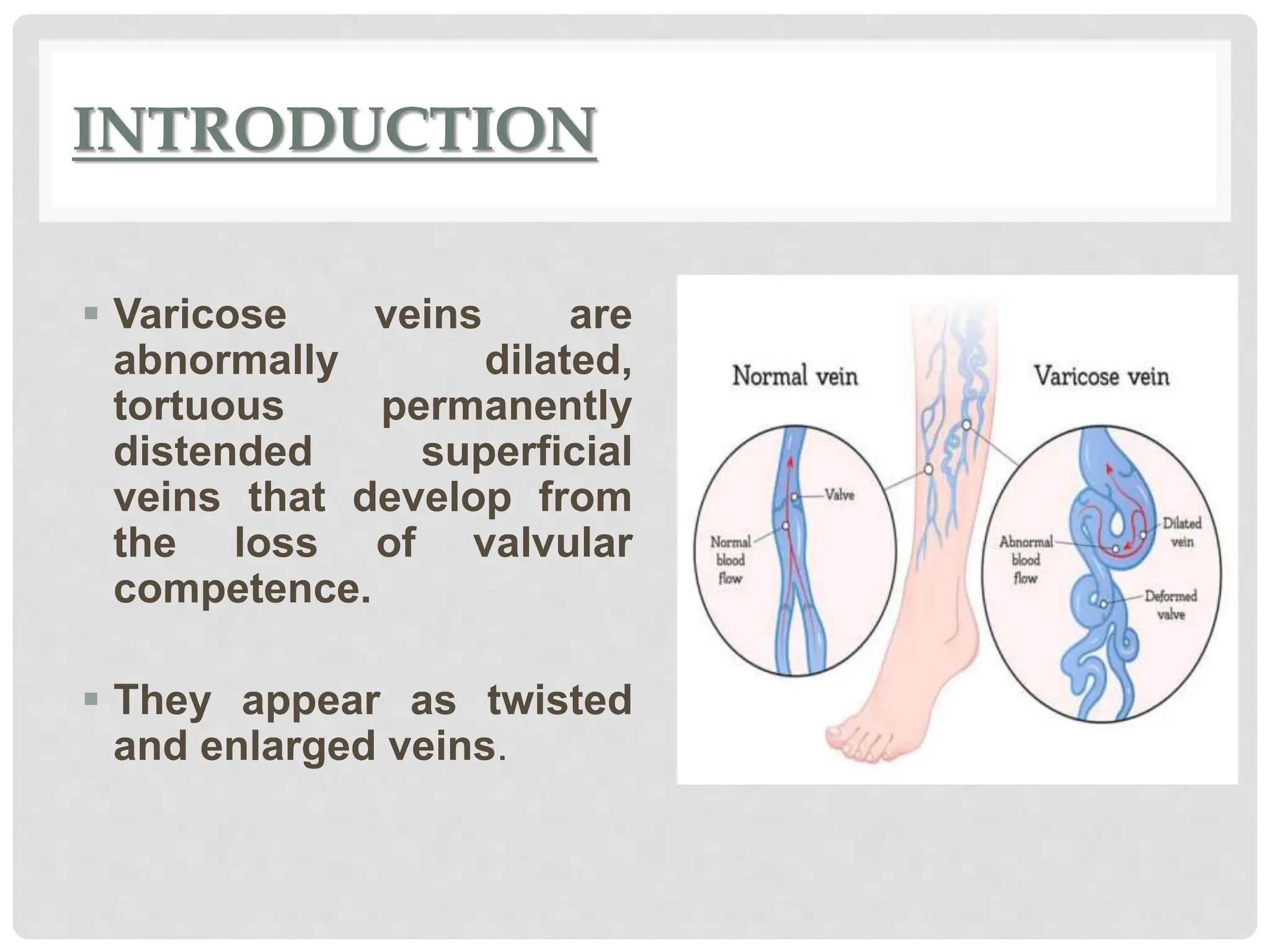VARICOSE VEIN.pptx