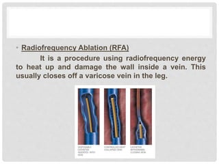VARICOSE VEIN.pptx