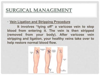 VARICOSE VEIN.pptx