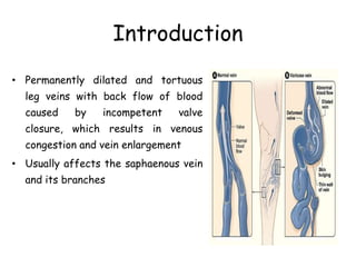 VARICOSE VEIN.ppt