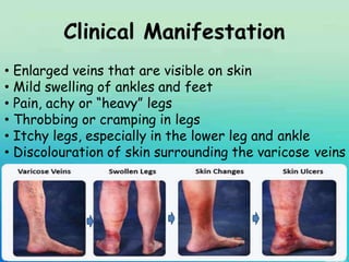 varicose vein.pptx