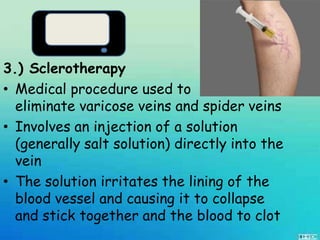varicose vein.pptx