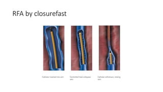 Varicose vein clinical presentation.pptx