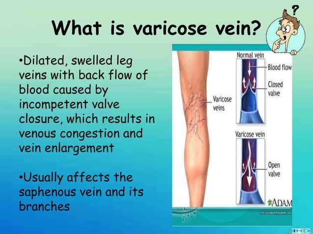 varicose vein.pptx adult health nursing ppt | PPT