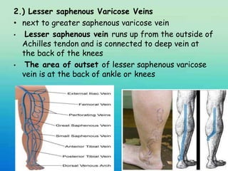 varicose vein.pptx adult health nursing ppt | PPTX