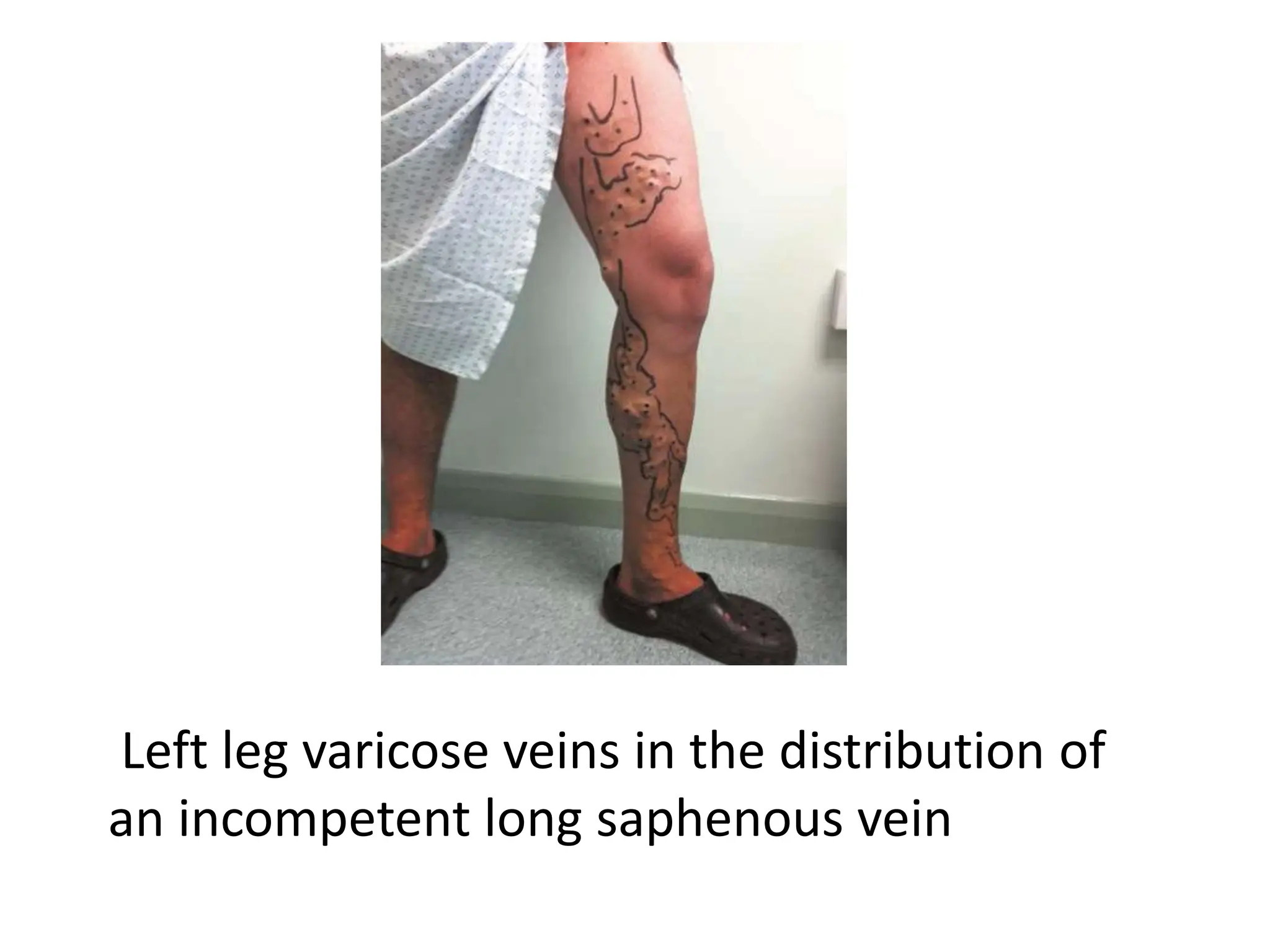 Varicose Vein and Venous Ulcer - Prof. Ri.pptx | Diseases and ...