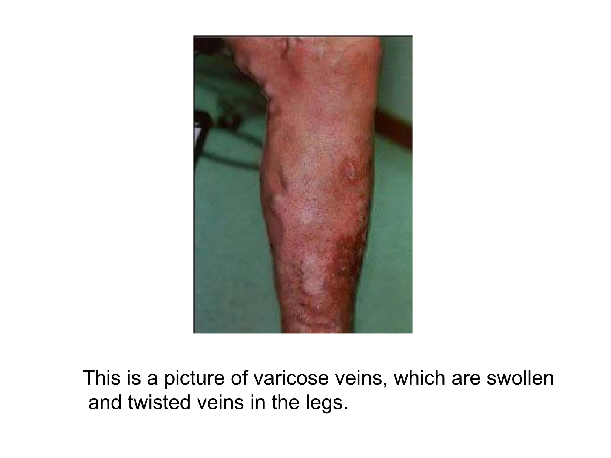 Varicose Vein and Venous Ulcer - Prof. Ri.pptx | Diseases and ...