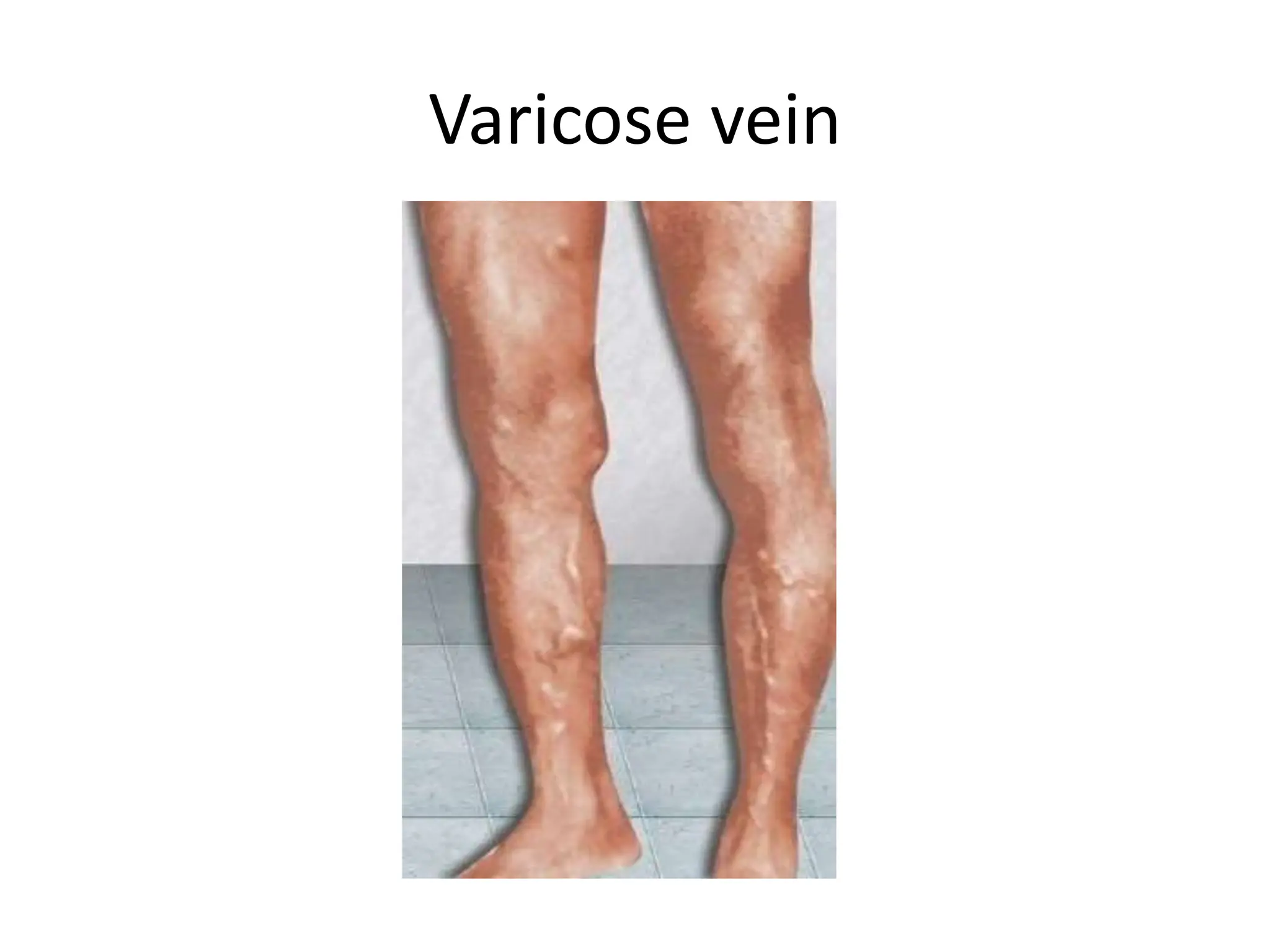 Varicose Vein and Venous Ulcer - Prof. Ri.pptx | Diseases and ...