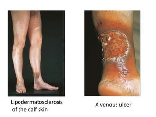 Varicose Vein and Venous Ulcer - Prof. Ri.pptx