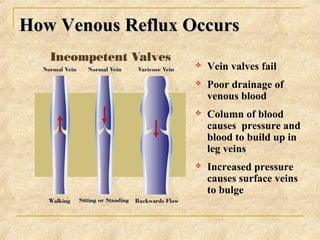 Varicose vein patient_talk | PPT