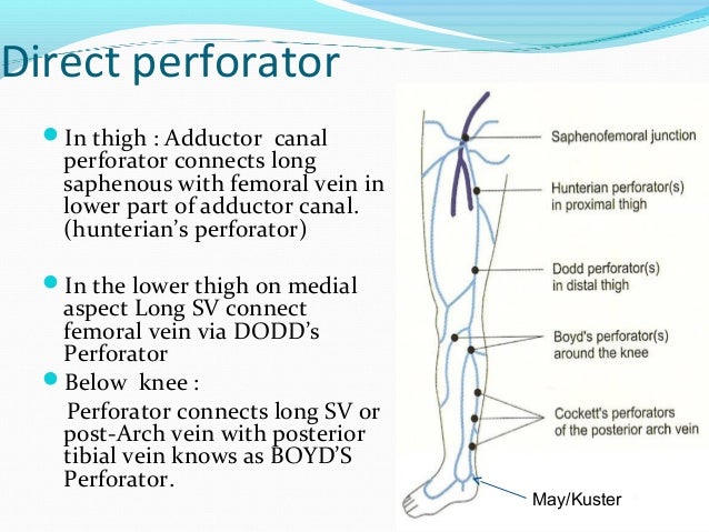 Varicose vein ppt (thu)