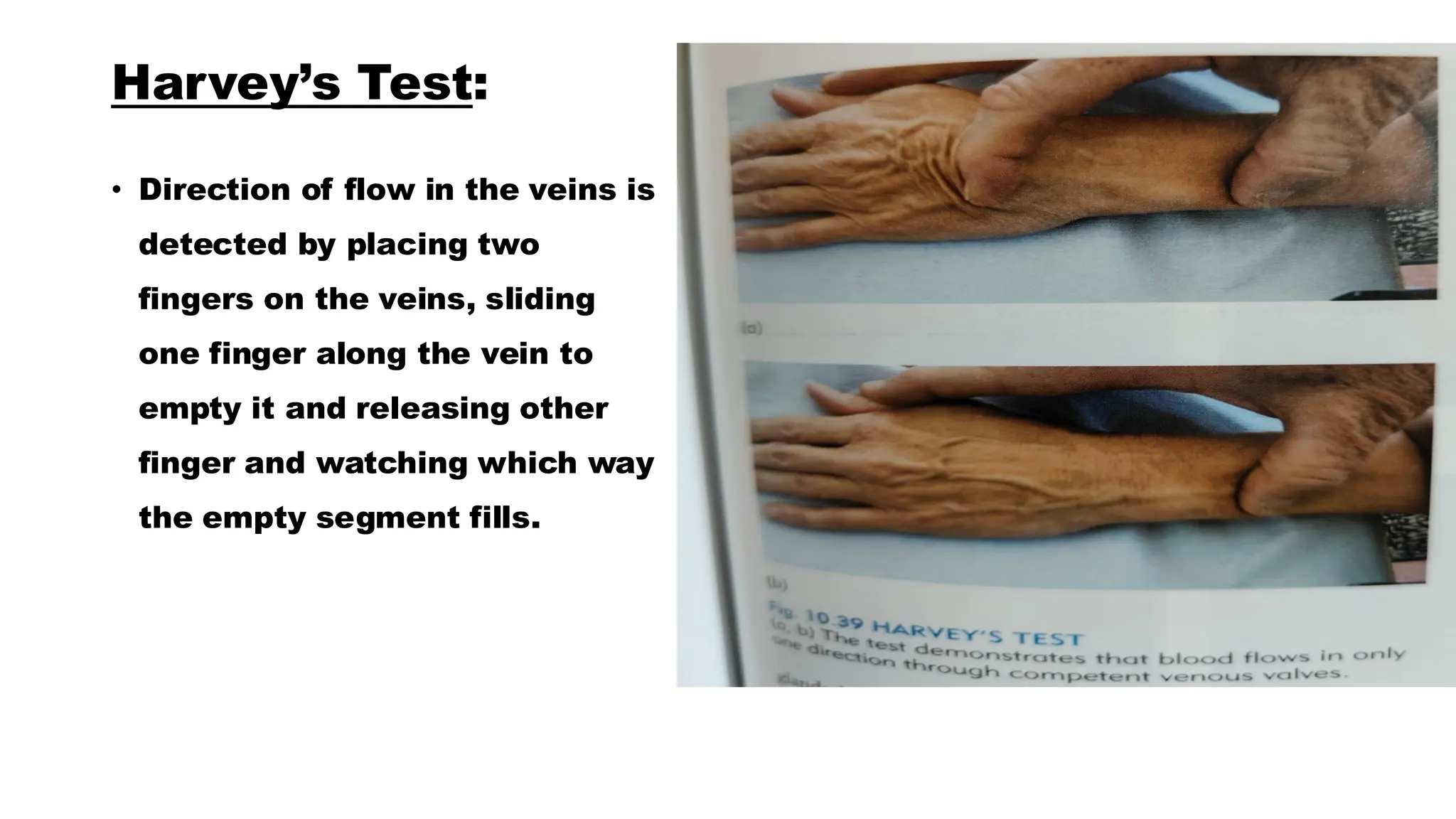 Anatomy of Varicose veins and its management | PPT